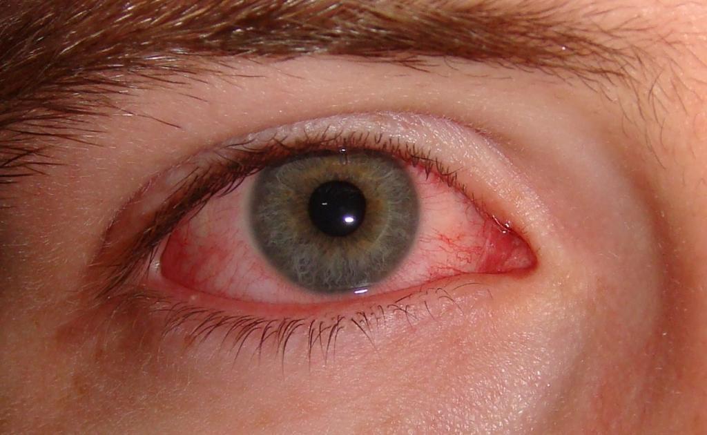 Conjunctivitis symptoms, causes and treatment. Is this disease contagious?